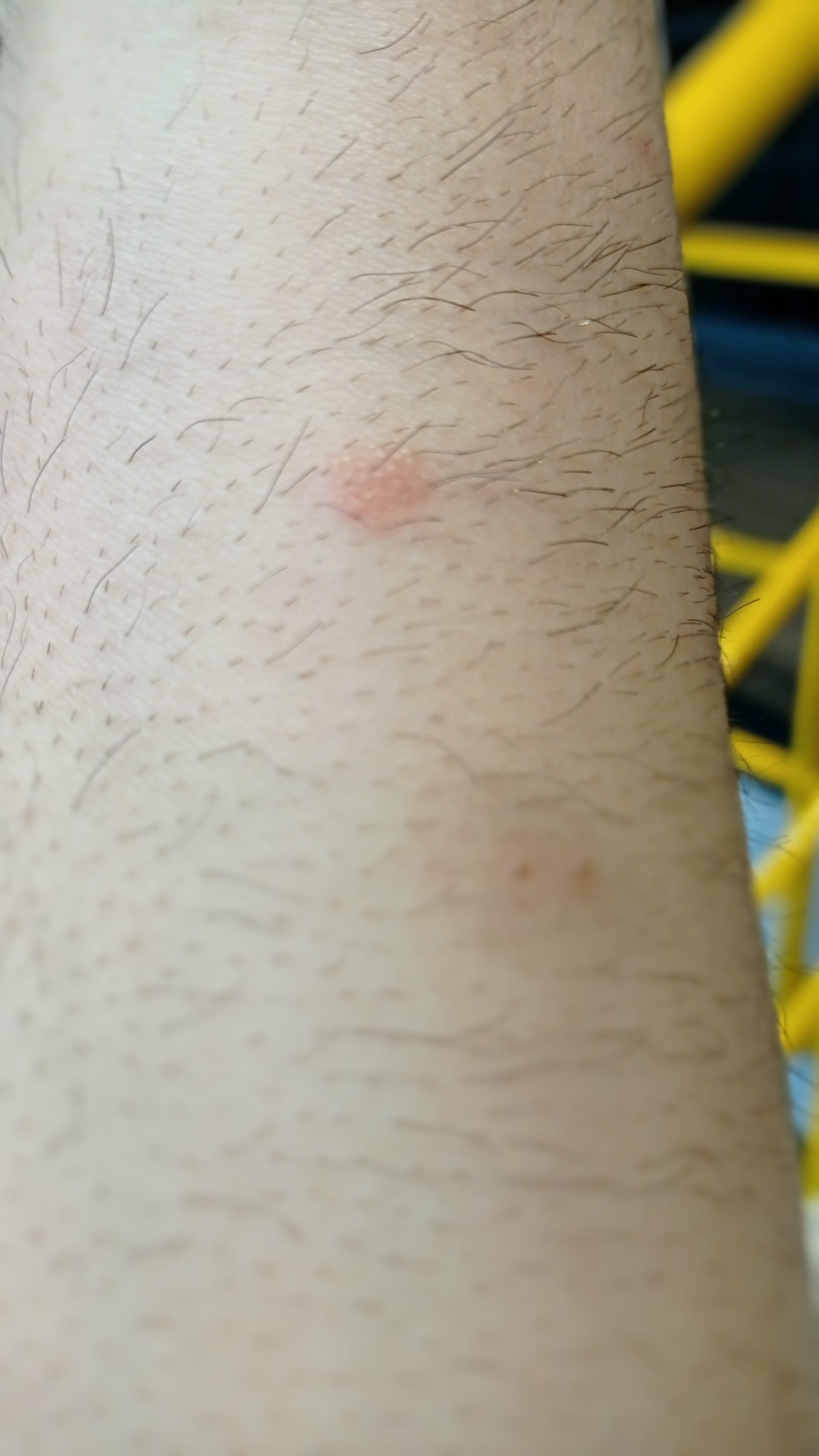 Me han salido unas manchas o ronchas en la piel - Dermatología ...