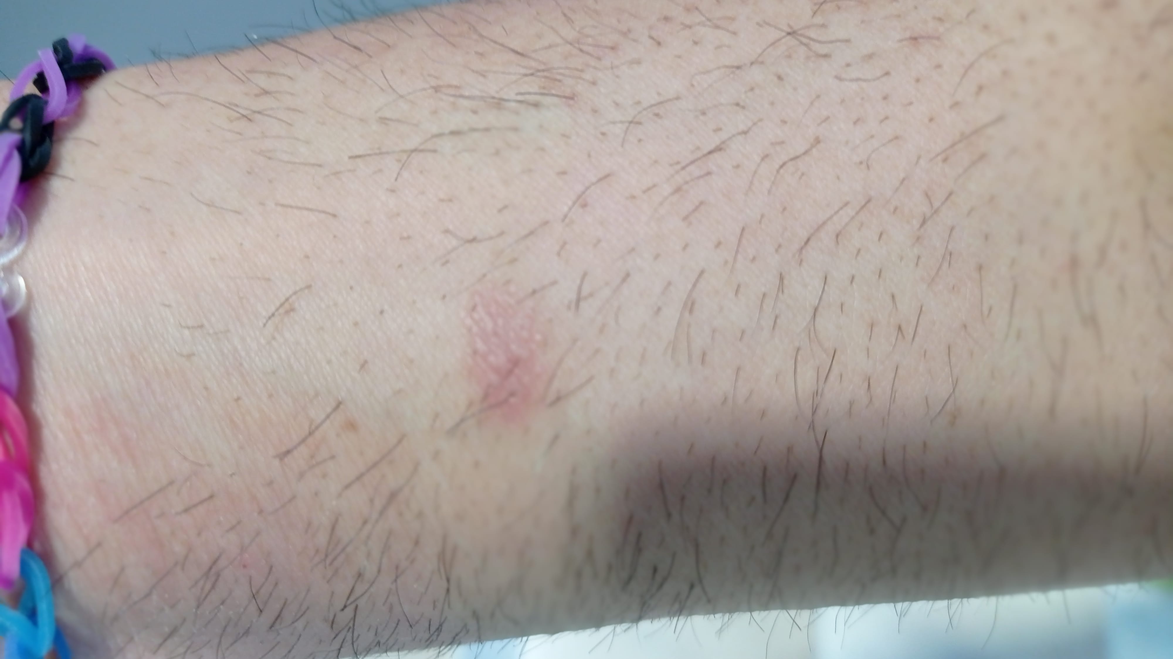 Me han salido unas manchas o ronchas en la piel - Dermatología ...