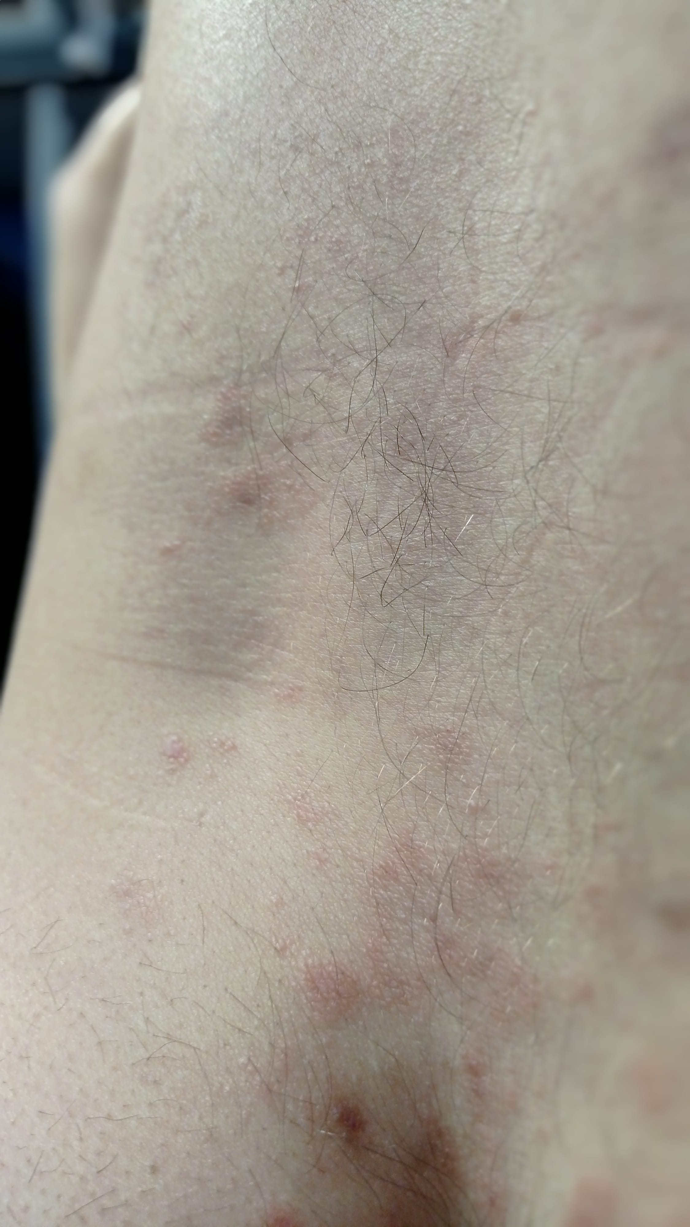 Me han salido unas manchas o ronchas en la piel - Dermatología ...