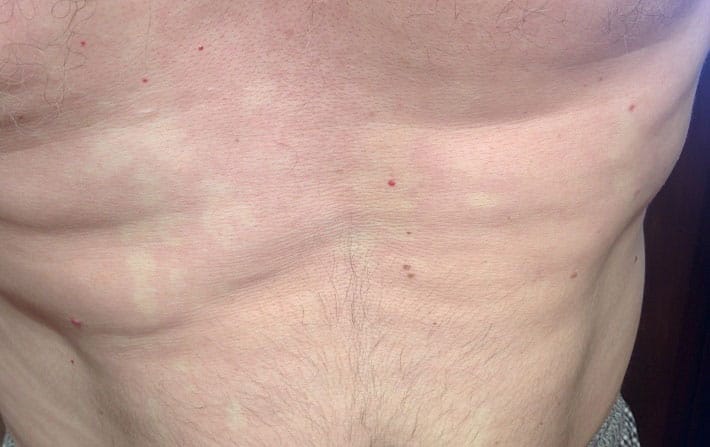 Ronchas en las manos y en el tórax - Dermatología - Todoexpertos.com